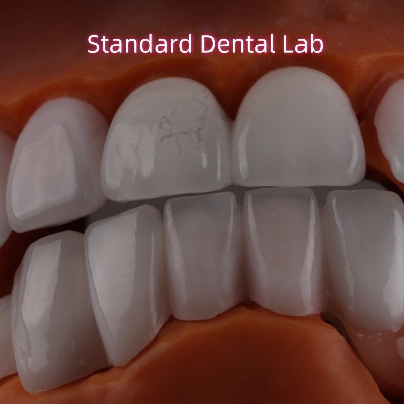 Lithium Dicilicate layer Ivoclar Emax Zirconia Laminate Veneers ...