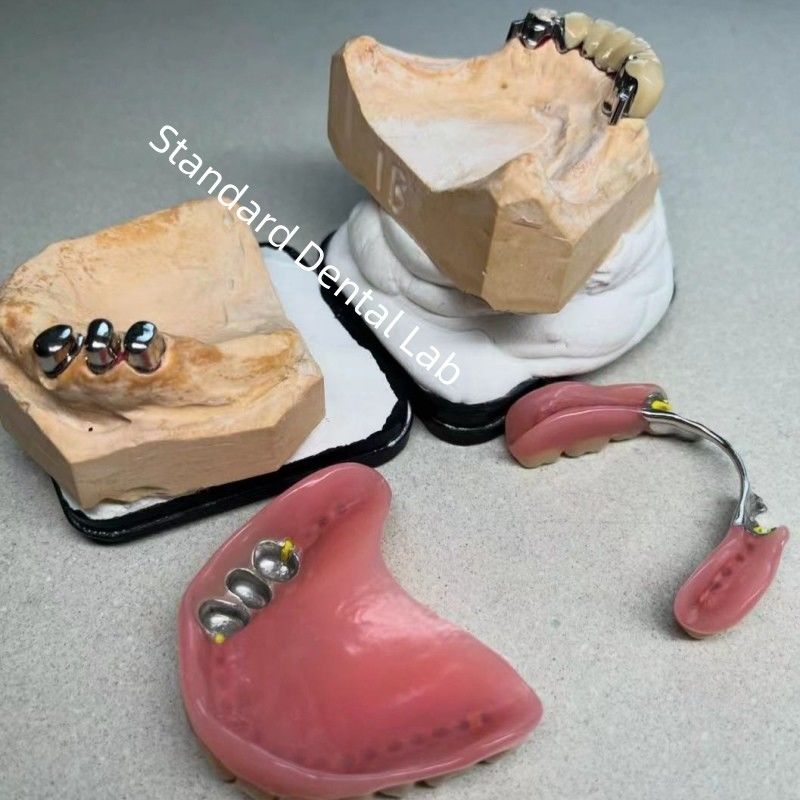 High Esthetics CAD CAM Tooth Partial Denture Attachment Replacement ...