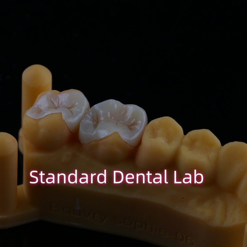 Composite Resin Zirconia Emax Metal Inlay Onlay Overlay