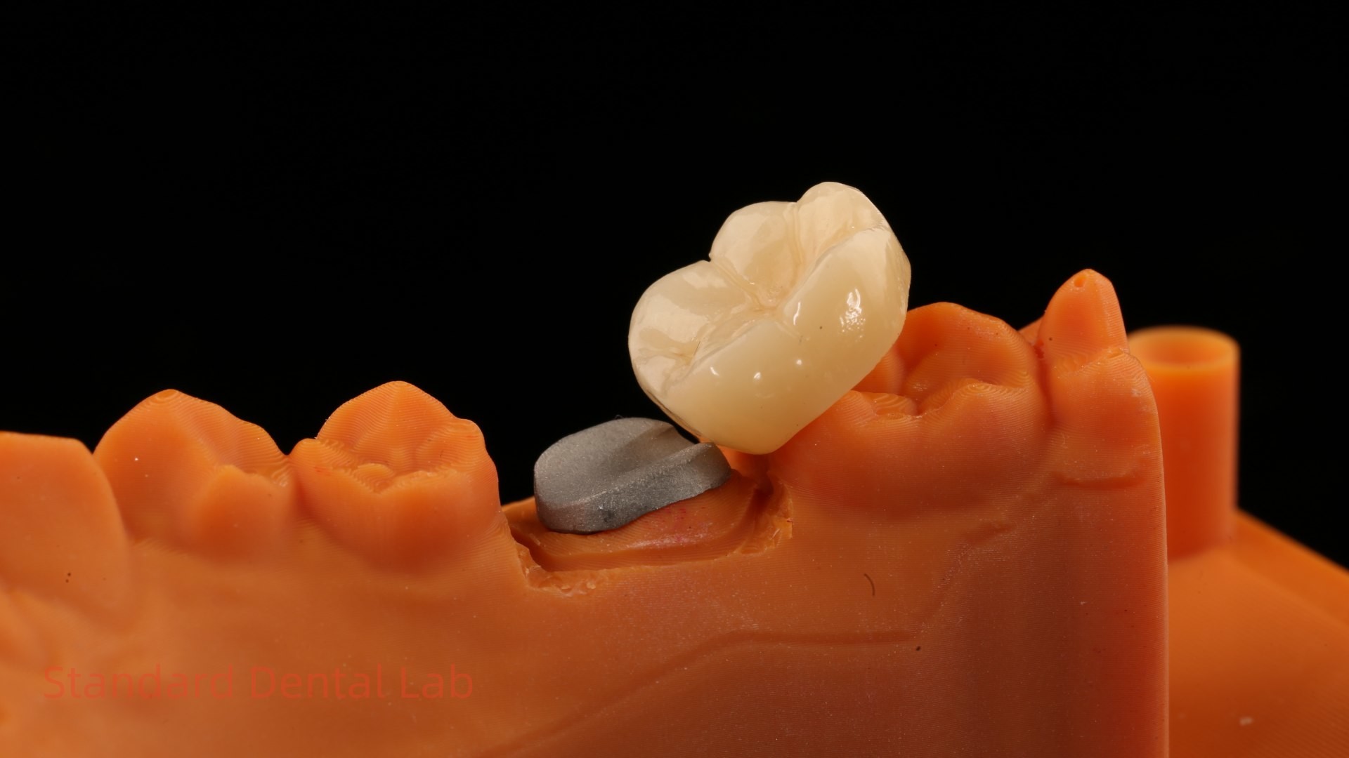 High Aesthetic Full Contour Zirconia Crown with Metal Post Core 5 Years ...